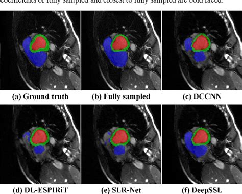 Figure 10 From Deep Separable Spatiotemporal Learning For Fast Dynamic Cardiac Mri Semantic