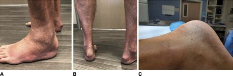 Jaaos Journal Of The American Academy Of Orthopaedic Surgeons