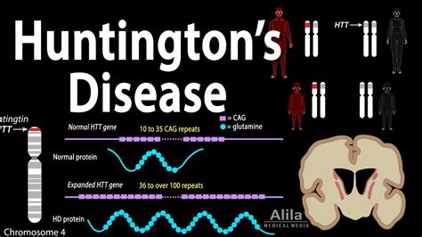 Huntingtons Disease Genetics Pathology And Symptoms Animation Youtube Huntingtons Disease Genetics Pathology And Symptoms Animation Youtube