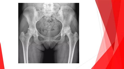 Differential Diagnosis Of Musculoskeletal Involvement In Rheumatoid Arthritis Sle And Systemic