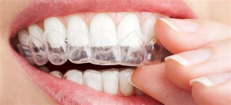 Избелване на зъби с шини в домашни условия Дентална практика Молдованови