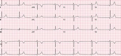 Bradycardia Sinus Bradycardia Causes Symptoms Diagnosis Treatment