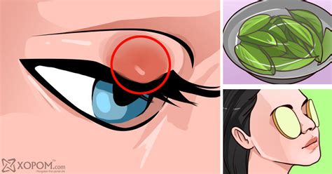 Нүдэн дээр гарсан өвдгийг буруу эмчилж дордуулах хэрэггүй Нэн яаралтай дараах 7 арга хэмжээг