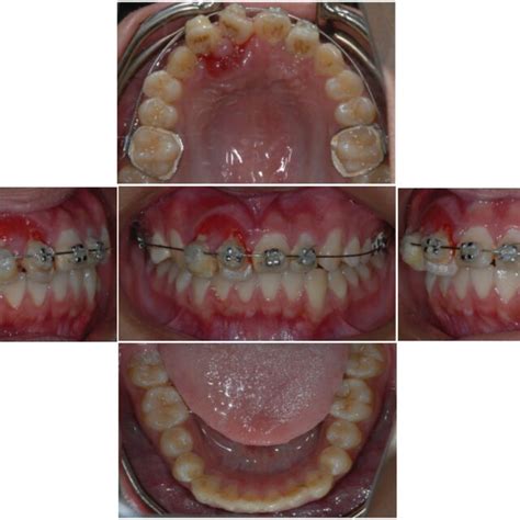 Inflammation Relief But Significant Gingival Defect And Recession After