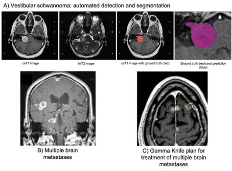 Phd Opportunity On Artificial Intelligence Driven Radiosurgery