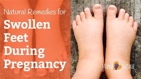Swollen Feet During Pregnancy Natural Remedies
