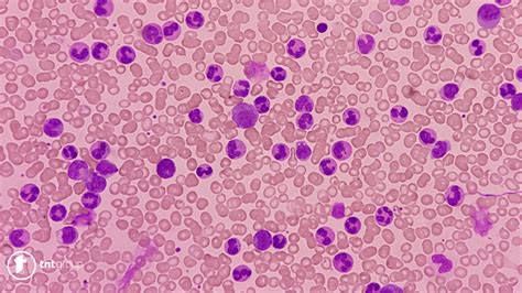 Kronična Mijeloična Leukemija 5 Prvih Simptoma