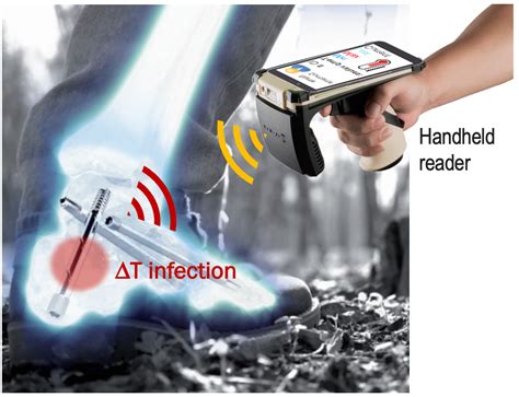 Augmented Implanted Orthopedic Fixators With An Embedded Temperature
