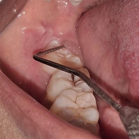 Dr Akriti Mishra On Linkedin Operculectomy Is A Minor Surgical Procedure Involving The Removal