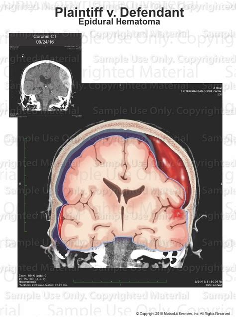 Epidural Hematoma Injury Motionlit