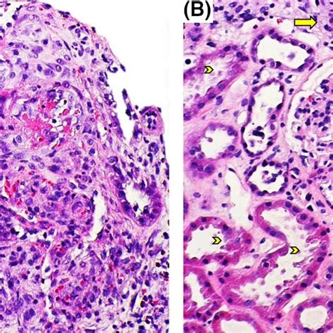 Renal Biopsy Demonstrating A A Medium‐sized Vessel With Transmural