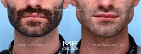 Jawline Filler For Men Transformative Before And After Photos Mabrie