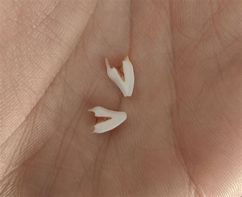 My Daughters Tooth Split In Half Mildlyinteresting