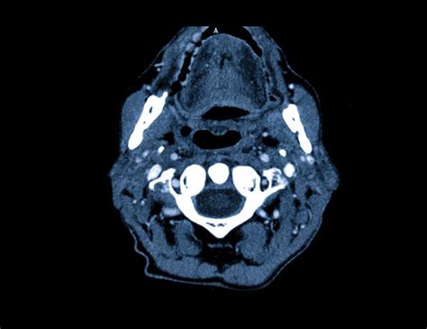 Лимфоузлы шеи схема кт