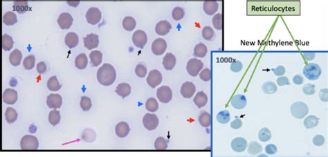 Module 2 Regenerative Anemia Parts A B And C Flashcards Quizlet