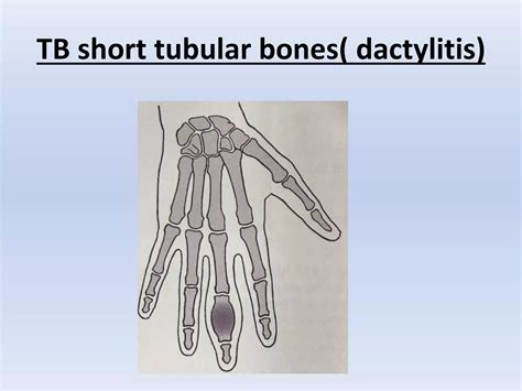 Tuberculosis Of Bone And Joints Ppt Tuberculosis Of Bone And Joints Ppt