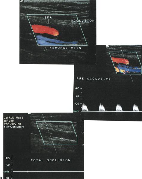 Duplex Evaluation Of Lower Extremity Arterial Occlusive Disease