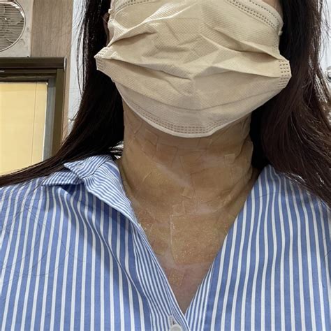 편평사마귀 Co2 레이저 제거 후기 듀오덤 알러지 관리법 가격 네이버 블로그