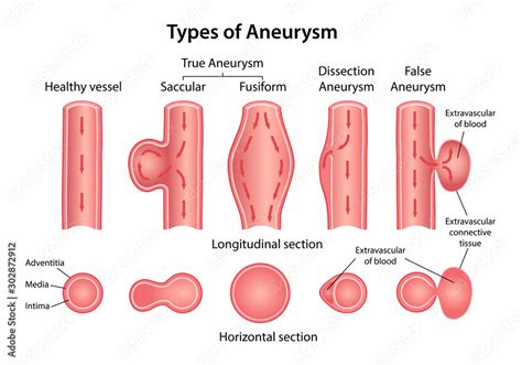 Dissecting Aneurysm