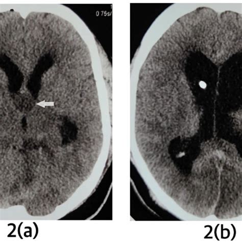 A Shows Hypodense Colloid Cyst In Third Ventricle Pointed By An Download Scientific Diagram