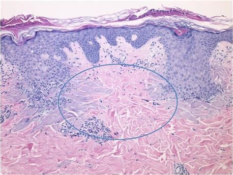 Histology Of Skin Treated With 60 Mjpin At 1 Week After The Treatment