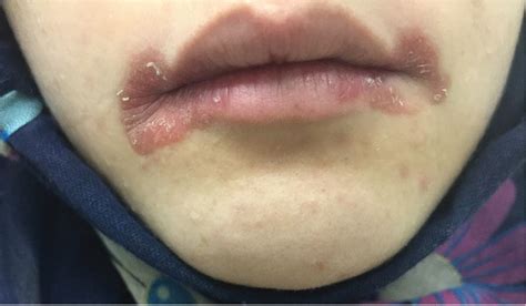 Infectious Cheilitis Infectious Cheilitis