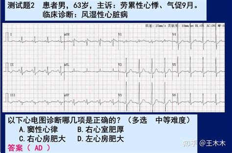心电图 心房肥大心室肥厚 知乎