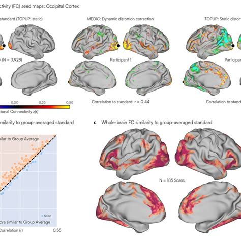 Comparison Of Dynamic Medic And Static Topup Distortion Correction Download Scientific
