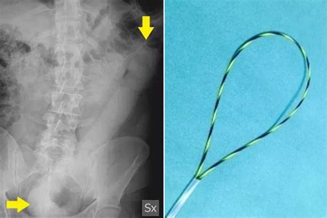 Doctors Invent Tool To Remove 23 Inch Sex Toy From Mans Colon