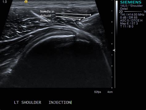 Shoulder Arthrogram Injection Shoulder Arthrogram Injection