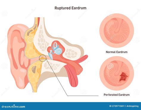 Ruptured Eardrum Anatomy Of The Human Ear Stock Vector Illustration Of Sensory Tube 273971569