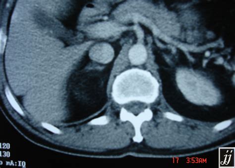 Right Adrenal Mass Radiopaedia