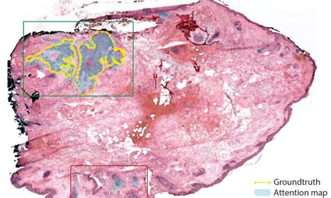 Bcc Ai Helps Identify Aggressive Types • Healthcare In