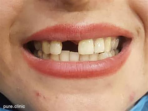 ایمپلنت در دندان های قدامی کلینیک دندانپزشکی پیور Pure Dental