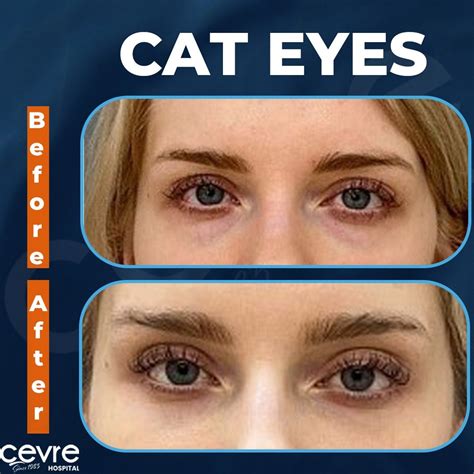 2024 Cat Eye Lift Canthoplasty In Istanbul Turkey Cost And Updates