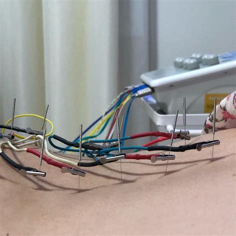 Mindra Clínica Mindra Acupuntura