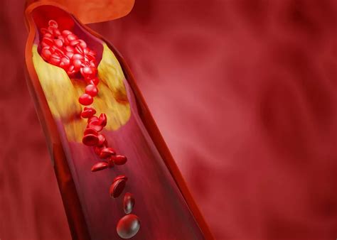 Understanding Hyperlipidemia A Deep Dive Into Causes Effects And