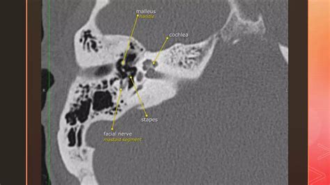 Anatomy Of Temporal Bone Final Pptx