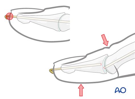 Joint Transfixation With K Wire For Dislocation Of The Distal Interphalangeal Joint