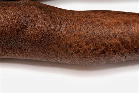Ichthyosis Types Symptoms And Treatment