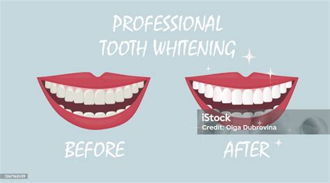 입을 크게 벌리고 있는 남자의 미소 치아 미백 치아 색상 비교 전후 매일 구강 위생 치과 디자인 포스터 플랫 일러스트레이션 개념과 주제에 대한 스톡 벡터 아트 및 기타