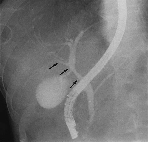 Radiologic Spectrum Of Cholangiocarcinoma Emphasis On Unusual Manifestations And Differential