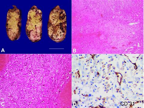A Gross View Of The Surgical Specimen Slices Of Right Hepatectomy Download Scientific Diagram