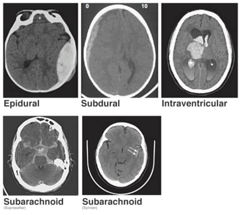 A Systematic Approach To The Interpretation Of Ct Head