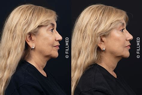 Nctf Boost 135ha Top Beauty