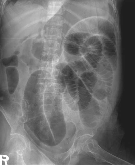 Miliary Metastases From Papillary Thyroid Cancer Artofit