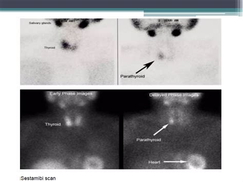 Laboratory And Radiological Findings In Hyperparathyroidism Ppt