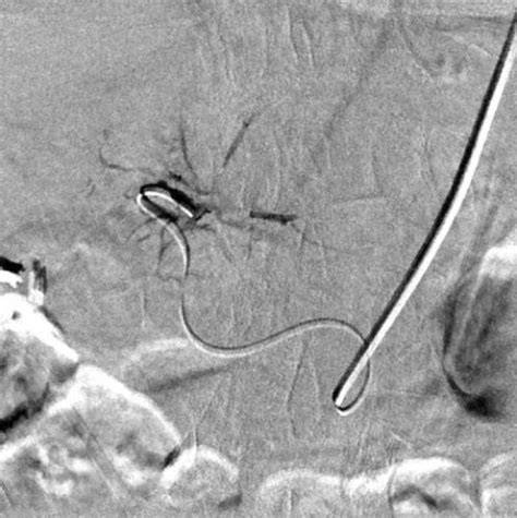 Superselective Arteriogram Of Left Hepatic Artery Segment 2 3 Following Download Scientific