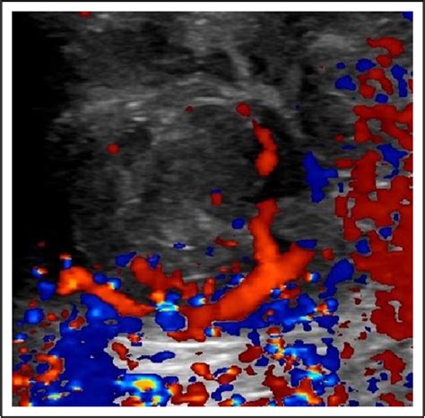 Figure 3 From Subcutaneous Leiomyosarcoma Of The Scrotum A Case Presentation And Review Of The