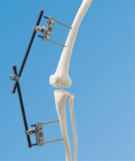 Orthopaedic Implants External Fixator System External Fixation And Orthopedic Fixation
